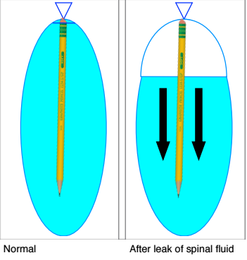 Spinal Headache – Obstetrical Anesthesia Associates